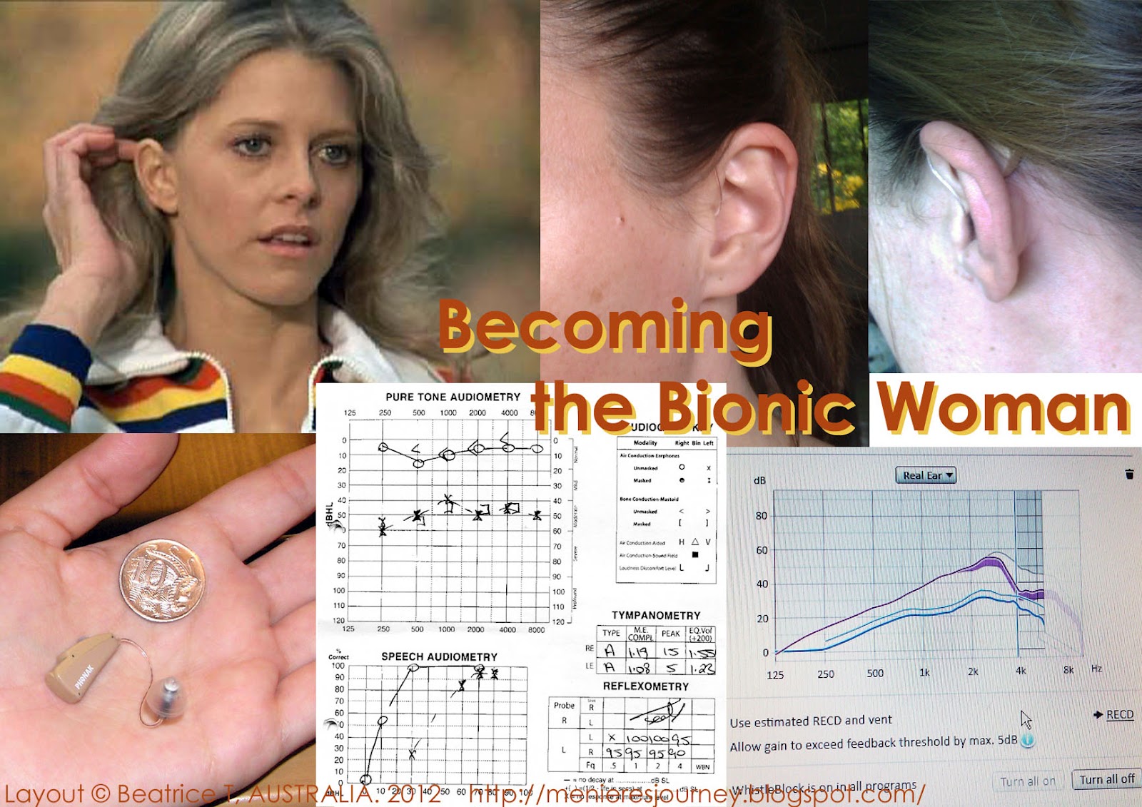 Menieres: An Inner (Ear) Journey: Becoming the Bionic Woman: Hearing ...