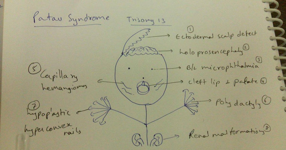 Medicowesome: Patau syndrome notes