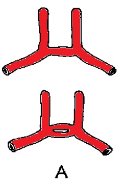 Dr Balaji Anvekar FRCR: Anterior cerebral artery