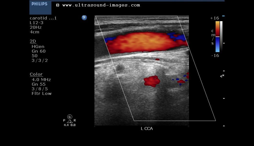 cochinblogs: Quiz- carotid Doppler study- severe external carotid ...