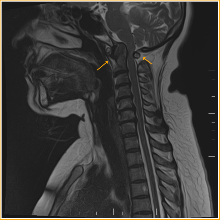 Basilar Invagination-MRI - Sumer's Radiology Blog