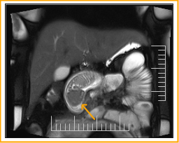 Small Bowel Intussusception Secondary to Polyp-MRI Diagnosis - Sumer's ...