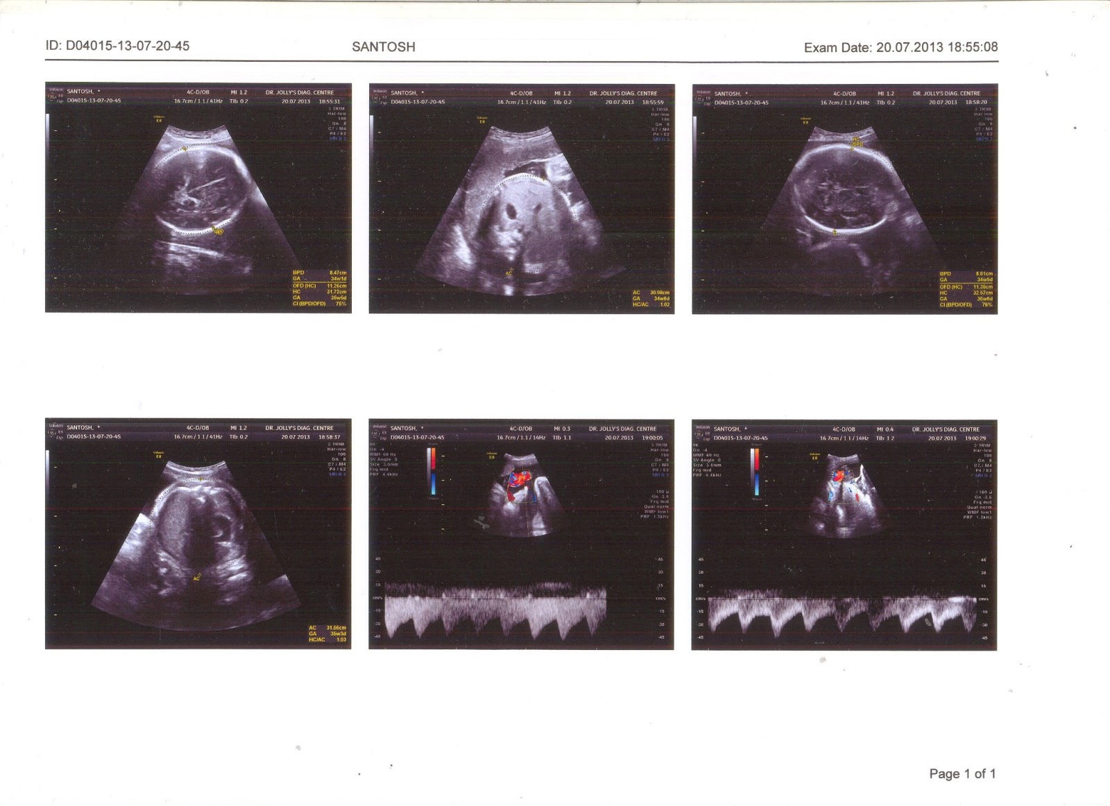 My Journey to Indian Surrogacy: USG Report..!!