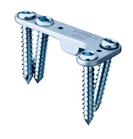 The Daily Fix: New Product: Vilex Opening Wedge Plate