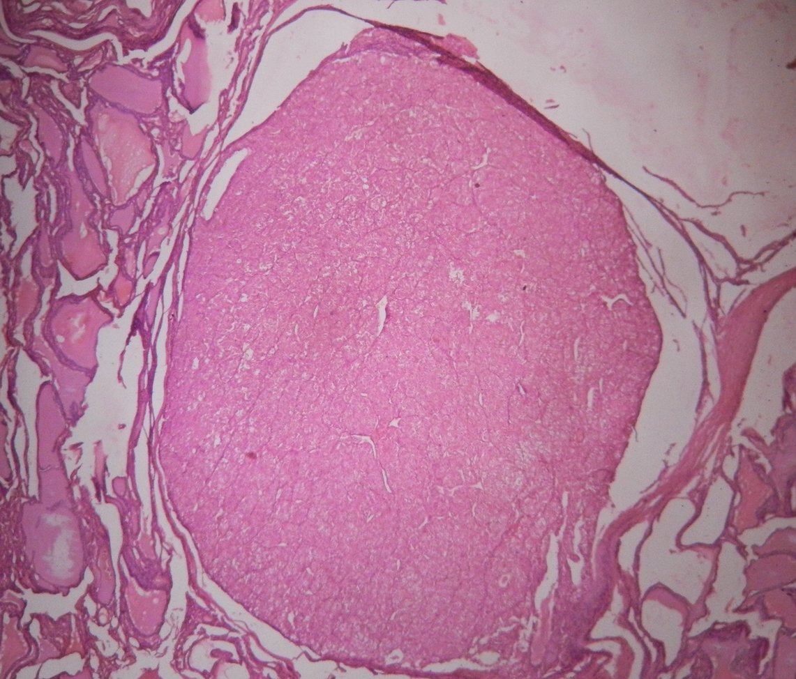 into the roots: Some thyroid lesions