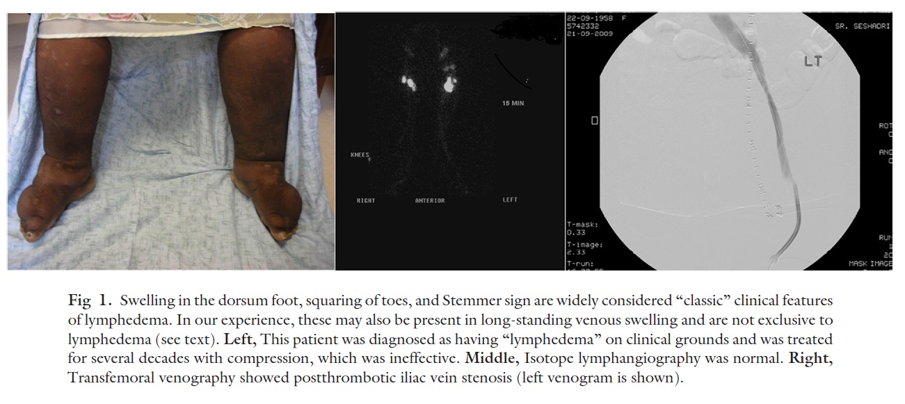Chronic Venous Insufficiency and Lymphedema : Venous Lymphedema