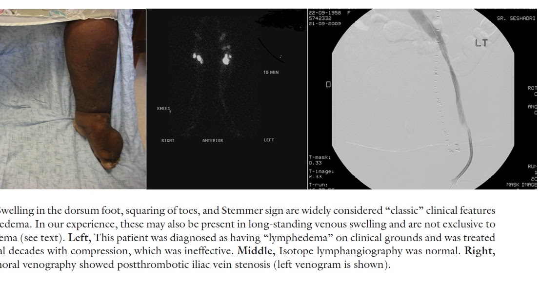 Chronic Venous Insufficiency and Lymphedema : Venous Lymphedema
