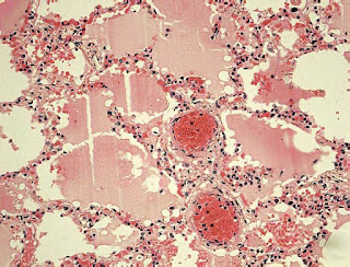 DESTINO MEDICO: MICROSCOPIO VIRTUAL PATOLOGIA PULMONAR - EDEMA PULMONAR