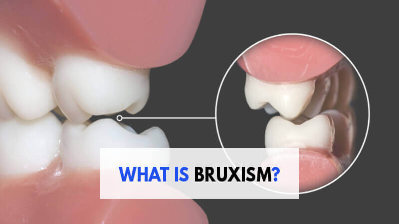What Is Bruxism? - Teroes