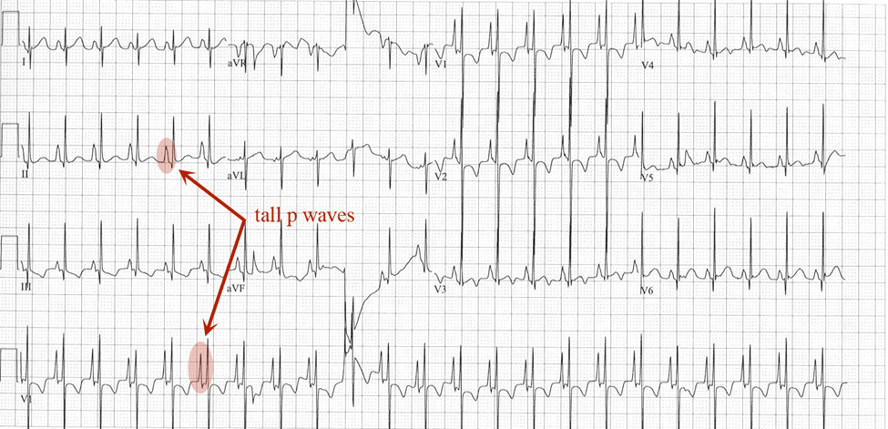 Right Atrial Enlargement | INA - ECG