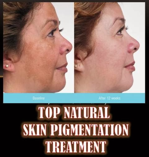 DAILY HEALTH & WELLNESS KNOWLEDGE: NATURAL SKIN PIGMENTATION TREATMENT