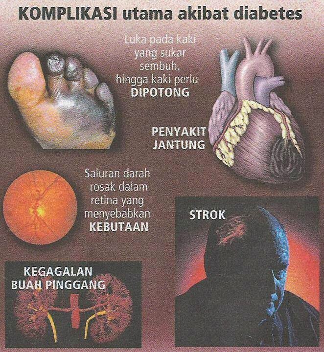 Cypreme 101: Komplikasi Utama Akibat Diabetes.