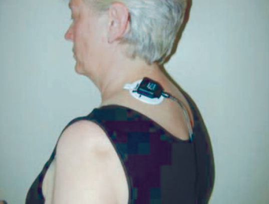 Emg test neck shoulder pain - etpantique