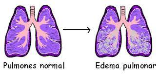 Edema Agudo De Pulmon - Todo sobre enfermería y medicina