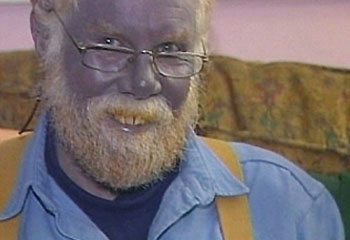 Weirdest Diseases___________