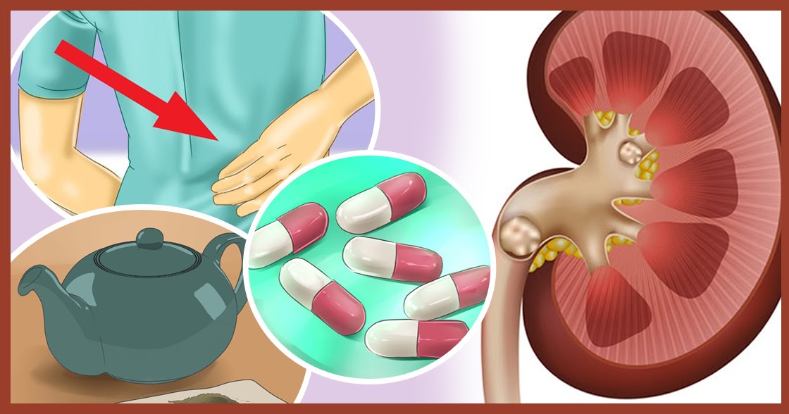 7 Unhealthy Habits Causing Kidney Stones And Their Preventions