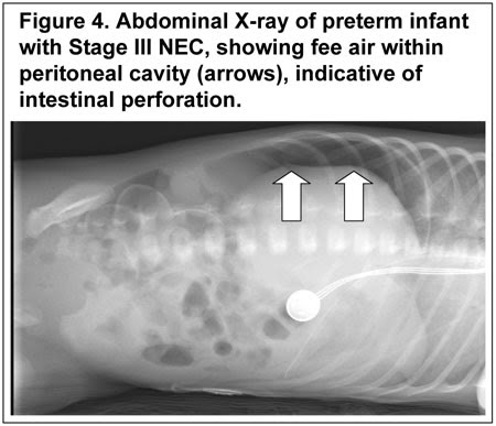 HEALTH FROM TRUSTED SOURCES: Necrotizing enterocolitis