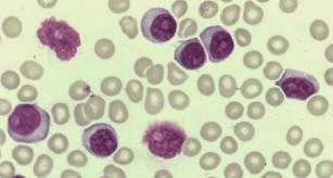 HEMATOLOGIA: PROLINFOCITO