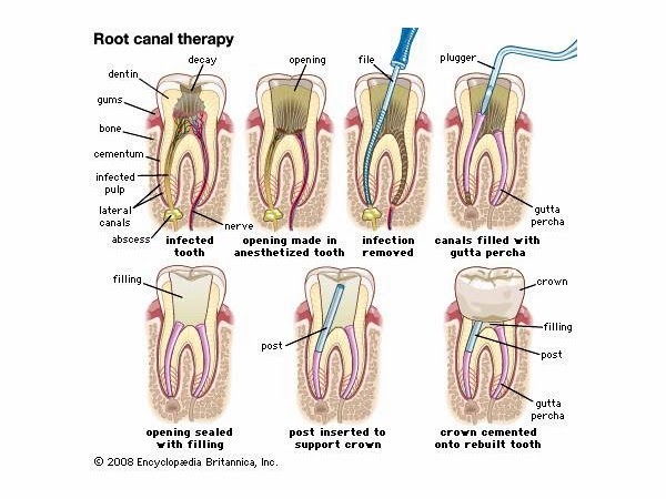 Mengapa Gigi Harus Dilakukan Perawatan Saluran Akar ? | Antam Medika