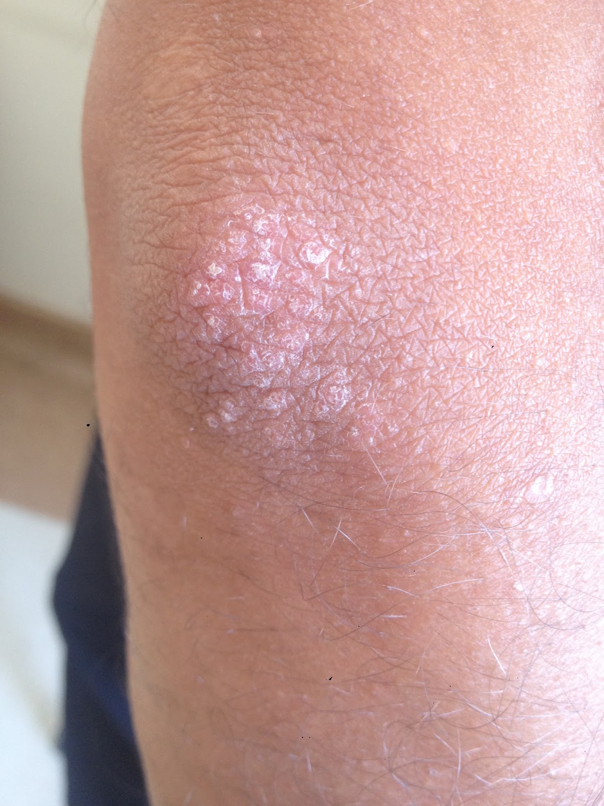 DERMATOSKOPİ ve TRİKOSKOPİ: PSÖRYAZİS VE SPLİNTER HEMORAJİ