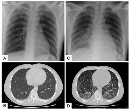 Medical Hemostat: TRALI - further evidence to minimize transfusion