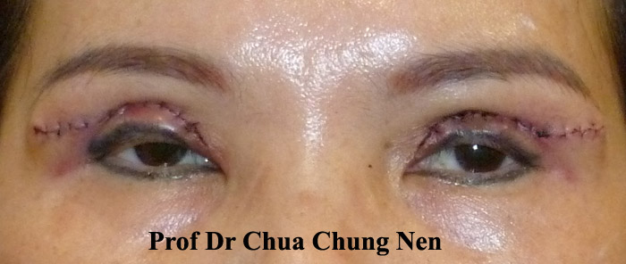 Eyelid Surgery by Prof Dr CN CHUA 蔡鐘能: Doc, Can You Remove the Excess ...