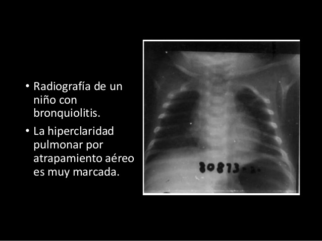 Análisis de placa de torax: BRONQUIOLITIS, BRONCONEUMONÍA Y NEUMOTORAX