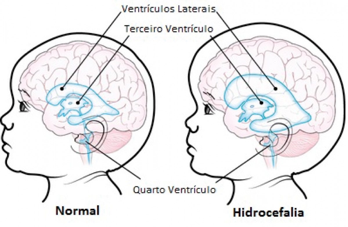 Neuropediatria em foco: O que é hidrocefalia?