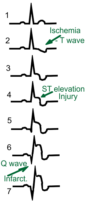 Ischemia Vs Infarction Ecg