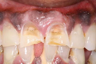 Crescent Dental on Blogspot!: Extreme Acid Tooth Erosion Due to Lemon ...