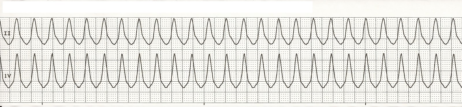 ACLS Rhythms: Ventricular rhythms