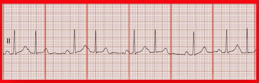 Float Nurse: Practice EKG Rhythm Strips 234
