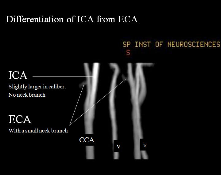 Dr Balaji Anvekar FRCR: Differentiation between ICA and ECA on MR Angio