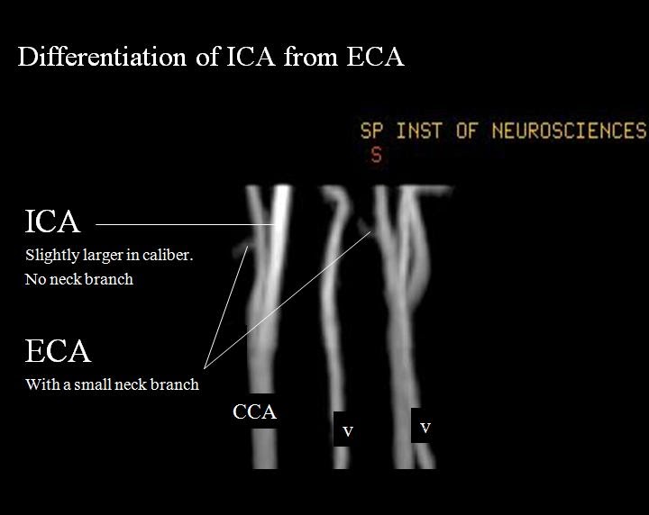 Dr Balaji Anvekar FRCR: Differentiation between ICA and ECA on MR Angio
