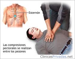 Primeros Auxilios: PARO RESPIRATORIO