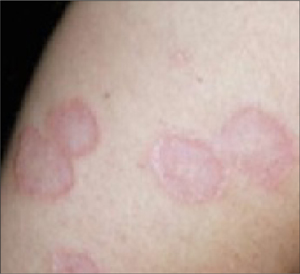 granuloma annulare: Granuloma Annulare means...