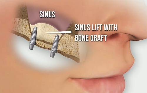 Las Vegas Oral Surgery: Sinus Lift Procedure