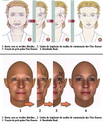 looks para o dia-a-dia: Fio Russo Plástica sem Cortes