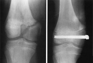 PEDIAFX: Fracturas en rodilla