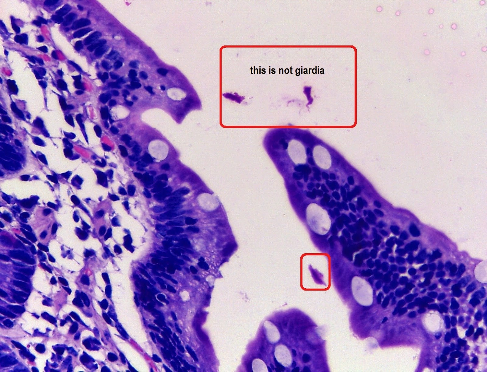 GASTROINTESTINAL AND LIVER HISTOLOGY PATHOLOGY ATLAS: DUODENUM : GIARDIASIS