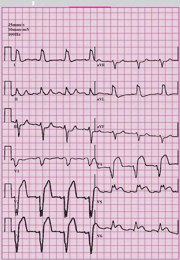 Vf Ecg Multiple