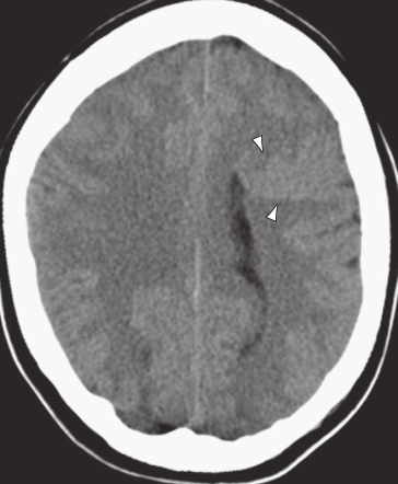 Schizencephaly-Mayo Radiology