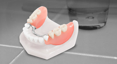 Removable Cast Partial Denture ~ Dr. Bharat Katarmal Dental & Implant ...