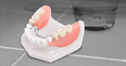 Removable Cast Partial Denture ~ Dr. Bharat Katarmal Dental & Implant ...