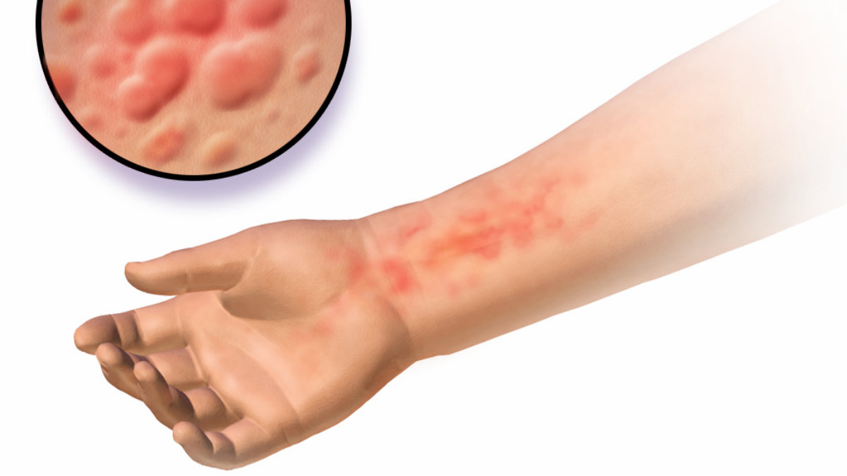 Urticaria