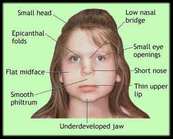 Birth Defects From Alcohol