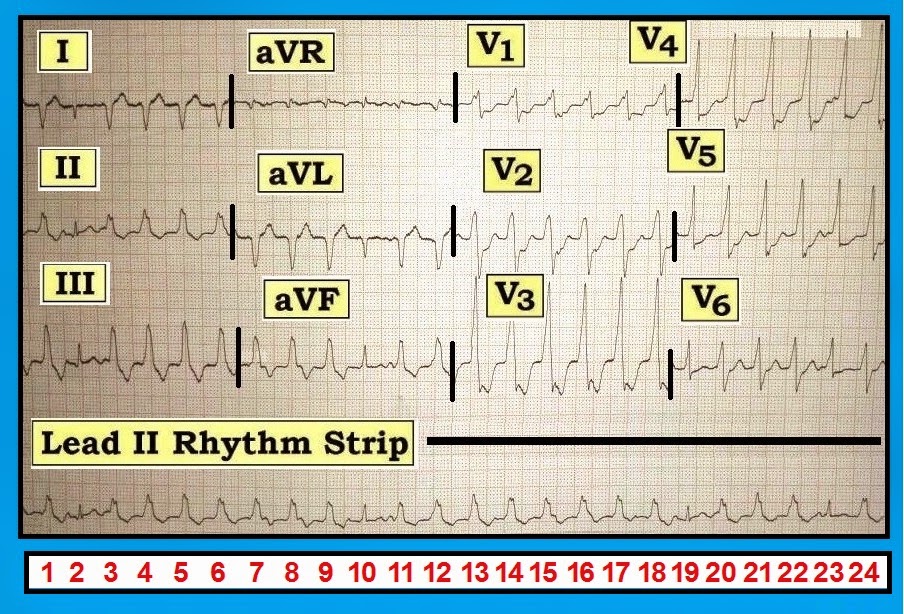 ECG Interpretation: December 2014