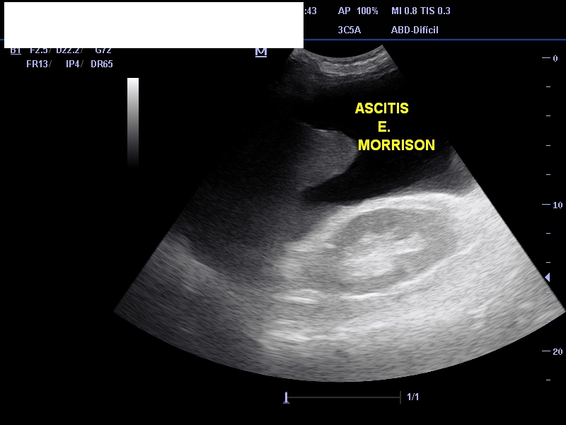 EcoCyl-Grupo: Ascitis