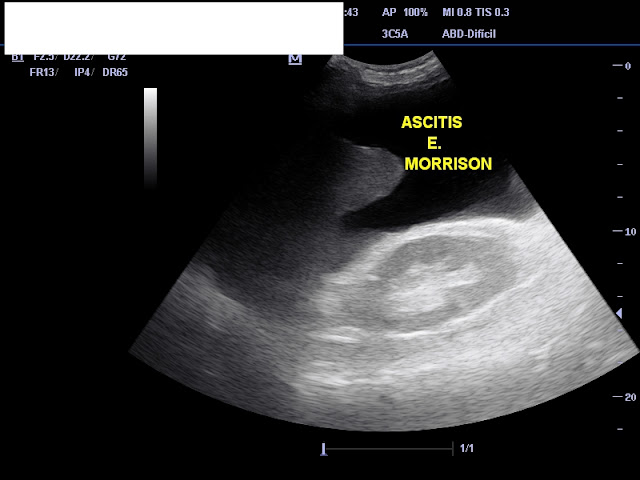 EcoCyl-Grupo: Ascitis
