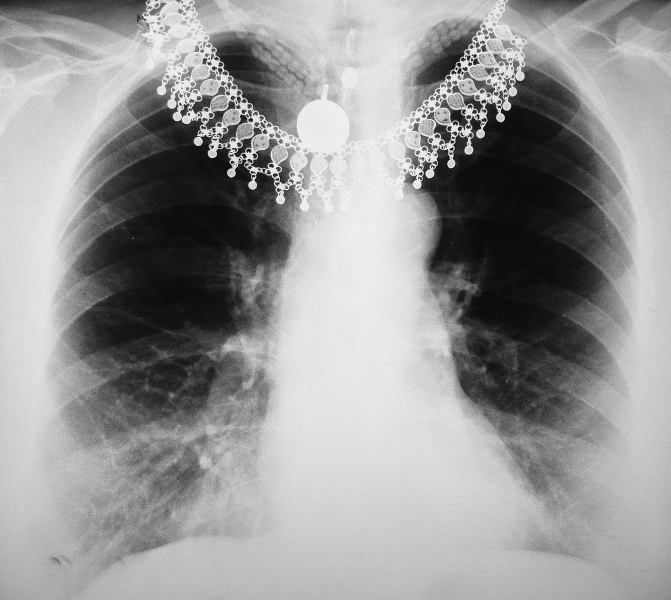 for the love of med school: Imaging Interstitial Lung Disease